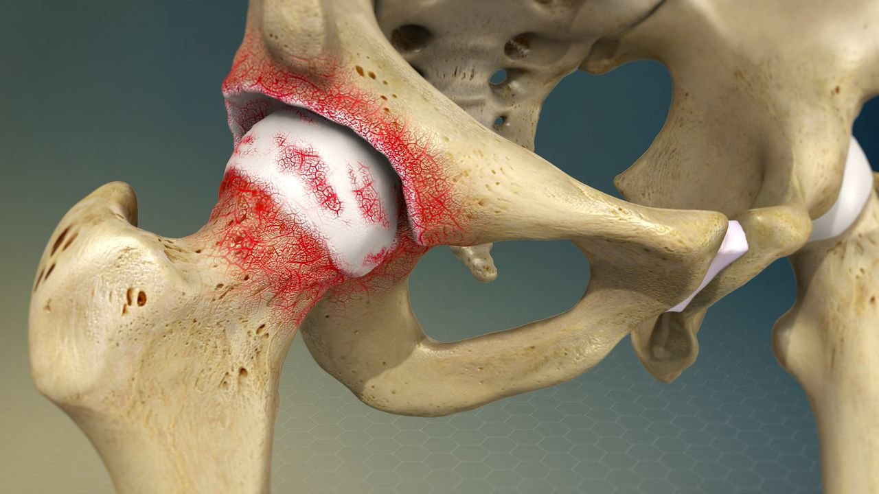 Hip Conditions - Dr Antony Liddell